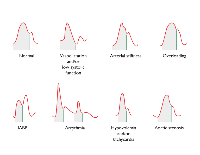 PRAM method – Hemodynamic Management / Vygon
